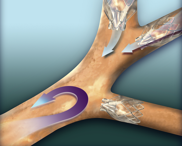 Pulmonx Fda Approves Zephyr Endobronchial Kaiser Permanente Ventures